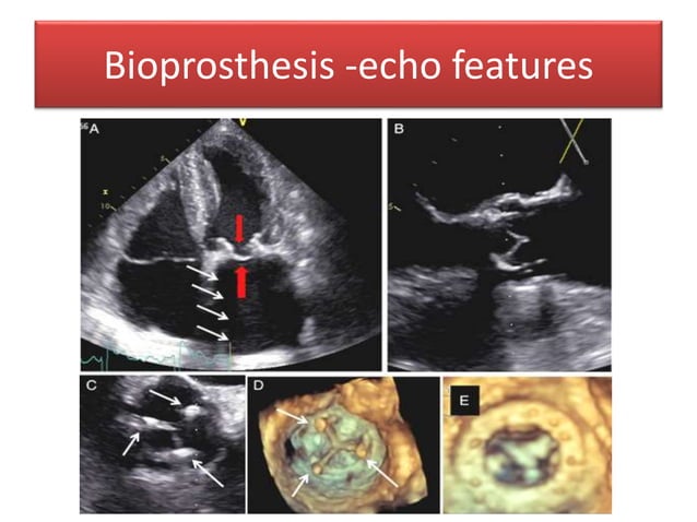 PROSTHETIC_VALVE_ECHO_ASSESSMENT_DR_SANTHOSH_CALICUTcardioSRcom.pptx ...