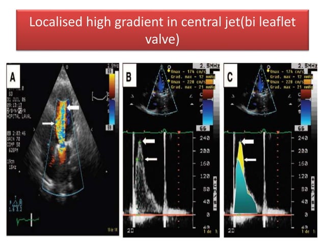 PROSTHETIC_VALVE_ECHO_ASSESSMENT_DR_SANTHOSH_CALICUTcardioSRcom.pptx ...