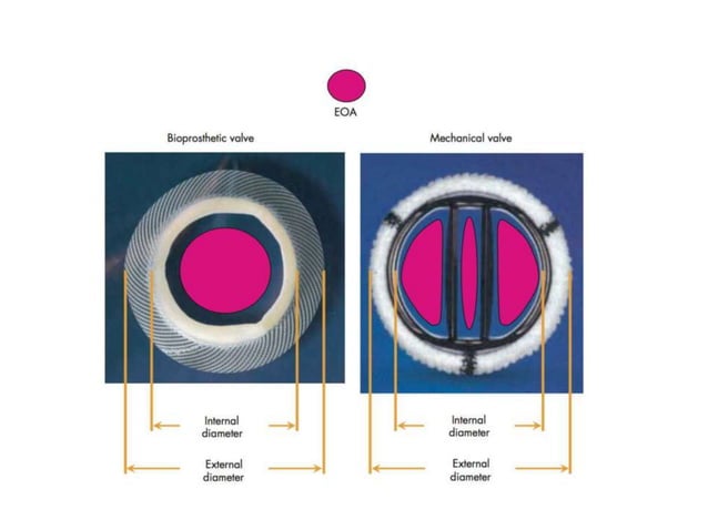 PROSTHETIC_VALVE_ECHO_ASSESSMENT_DR_SANTHOSH_CALICUTcardioSRcom.pptx ...