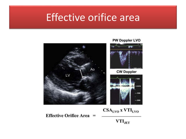 PROSTHETIC_VALVE_ECHO_ASSESSMENT_DR_SANTHOSH_CALICUTcardioSRcom.pptx ...