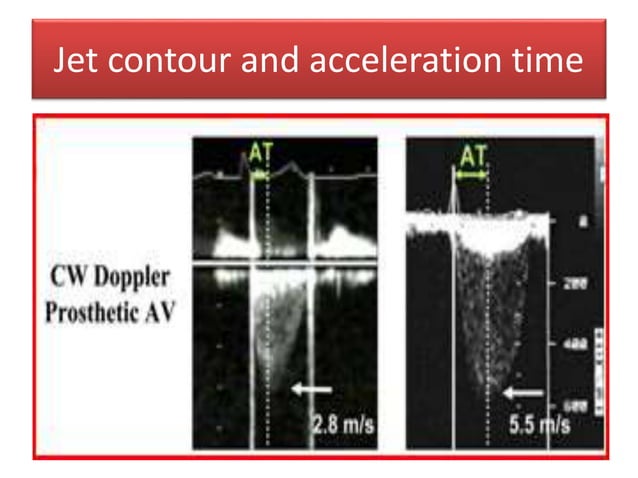 PROSTHETIC_VALVE_ECHO_ASSESSMENT_DR_SANTHOSH_CALICUTcardioSRcom.pptx ...