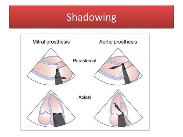 PROSTHETIC_VALVE_ECHO_ASSESSMENT_DR_SANTHOSH_CALICUTcardioSRcom.pptx ...