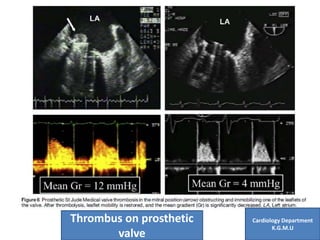 Prosthetic valve evaluation gaurav | PPTX