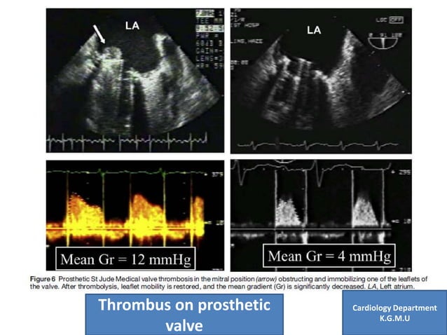 Prosthetic valve evaluation gaurav | PPTX | Heart and Cardiovascular ...