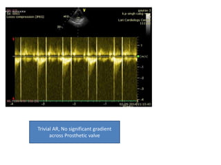 Prosthetic valve evaluation gaurav | PPTX
