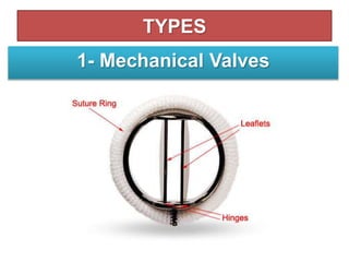 Prosthetic cardiac valves | PPTX