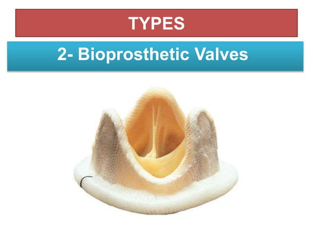 Prosthetic cardiac valves | PPTX