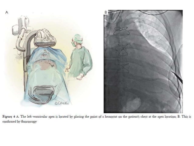 Prosthetic Cardiac Valves Ppt