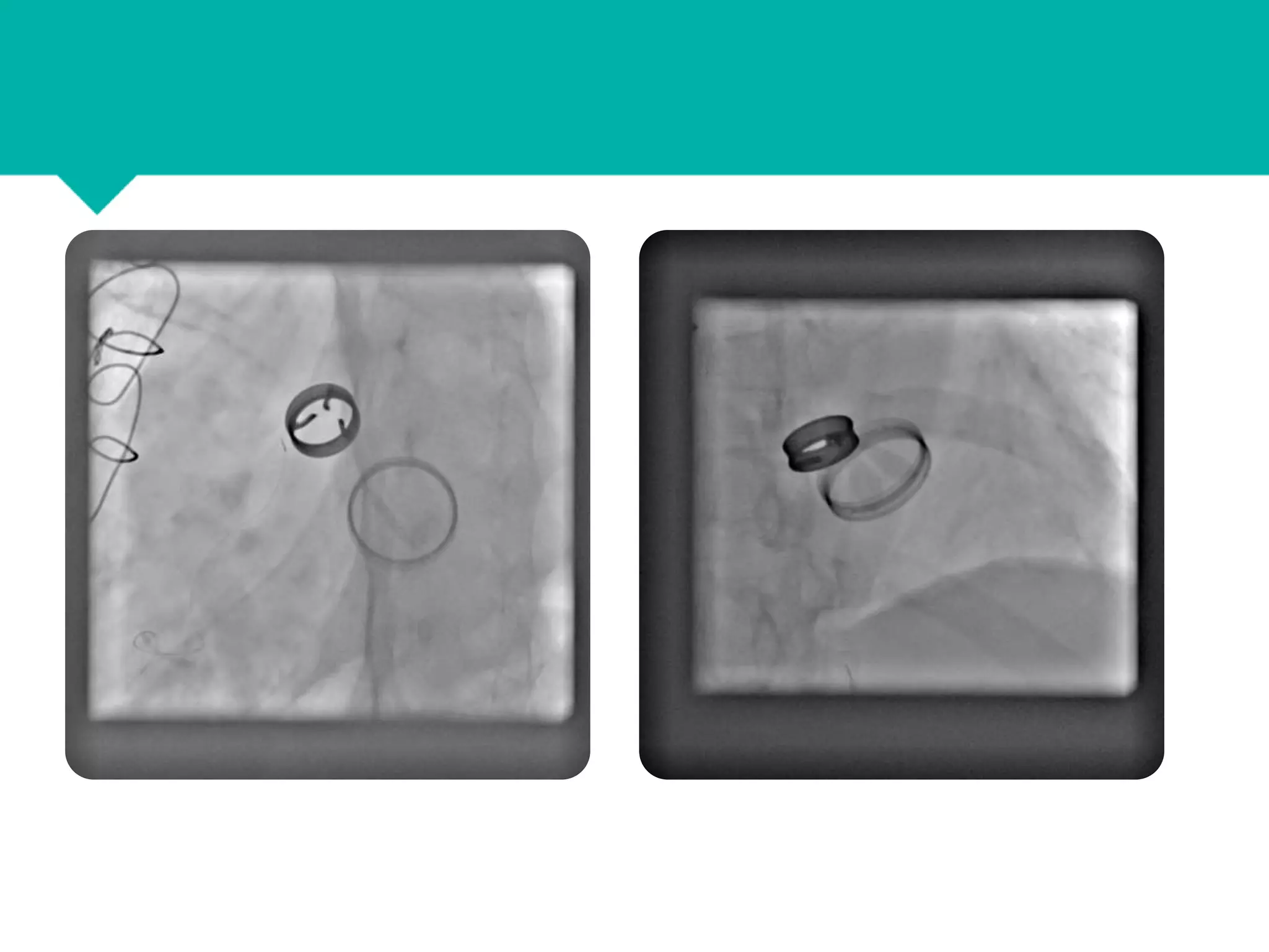 Prosthetic heart valves types physiology | PPTX