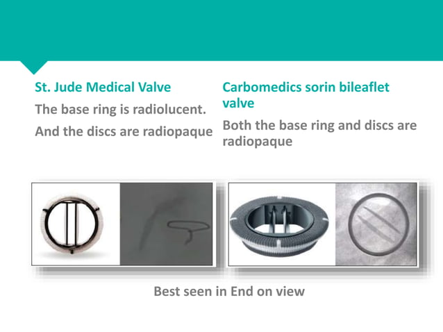 Prosthetic heart valves types physiology | PPTX
