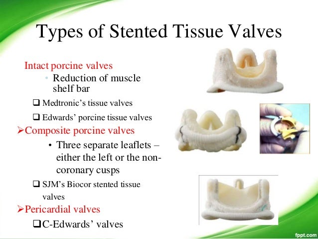 Prosthetic valves the past present and future i tammi raju