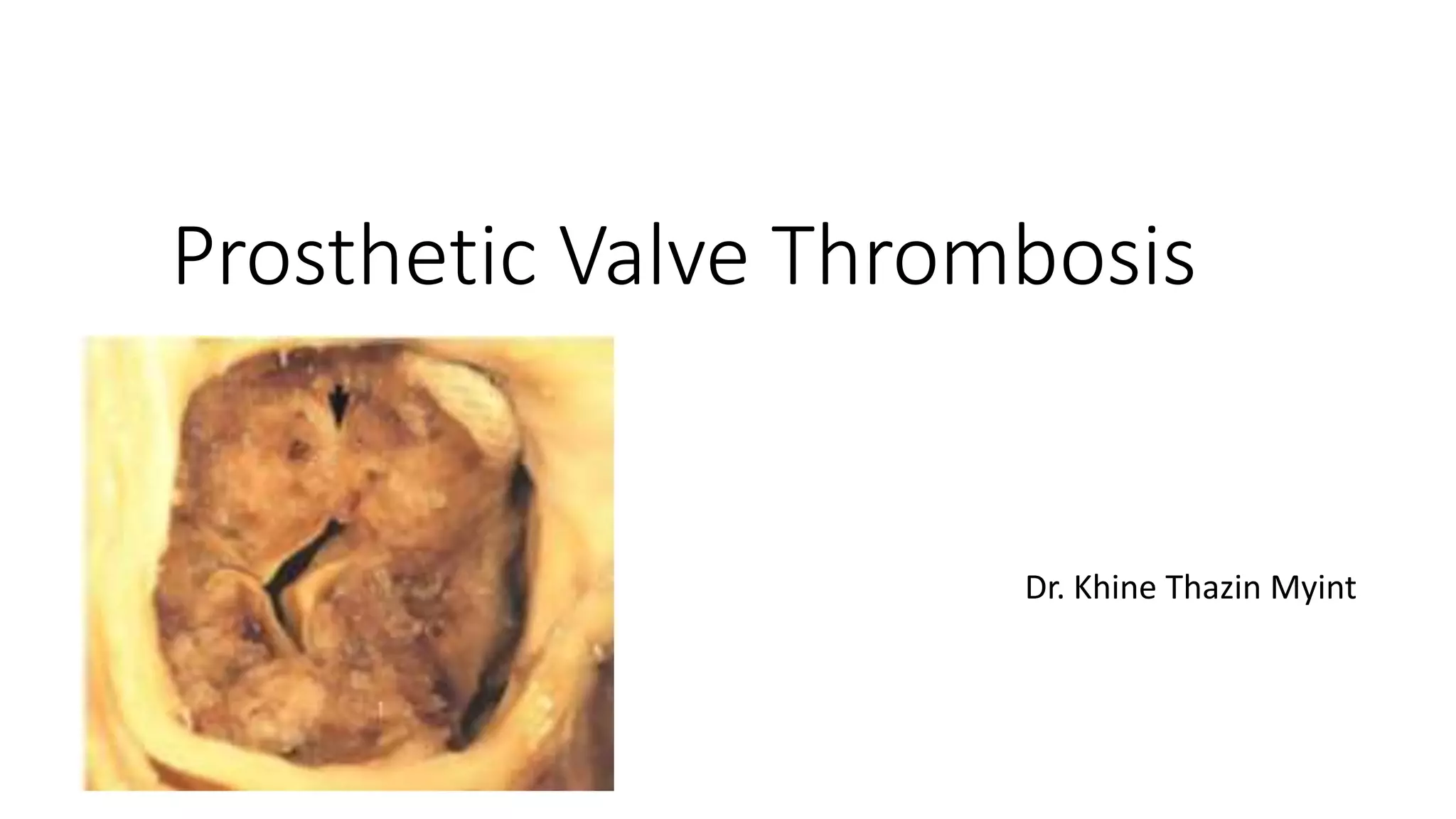 Prosthetic valve thrombosis | PPTX
