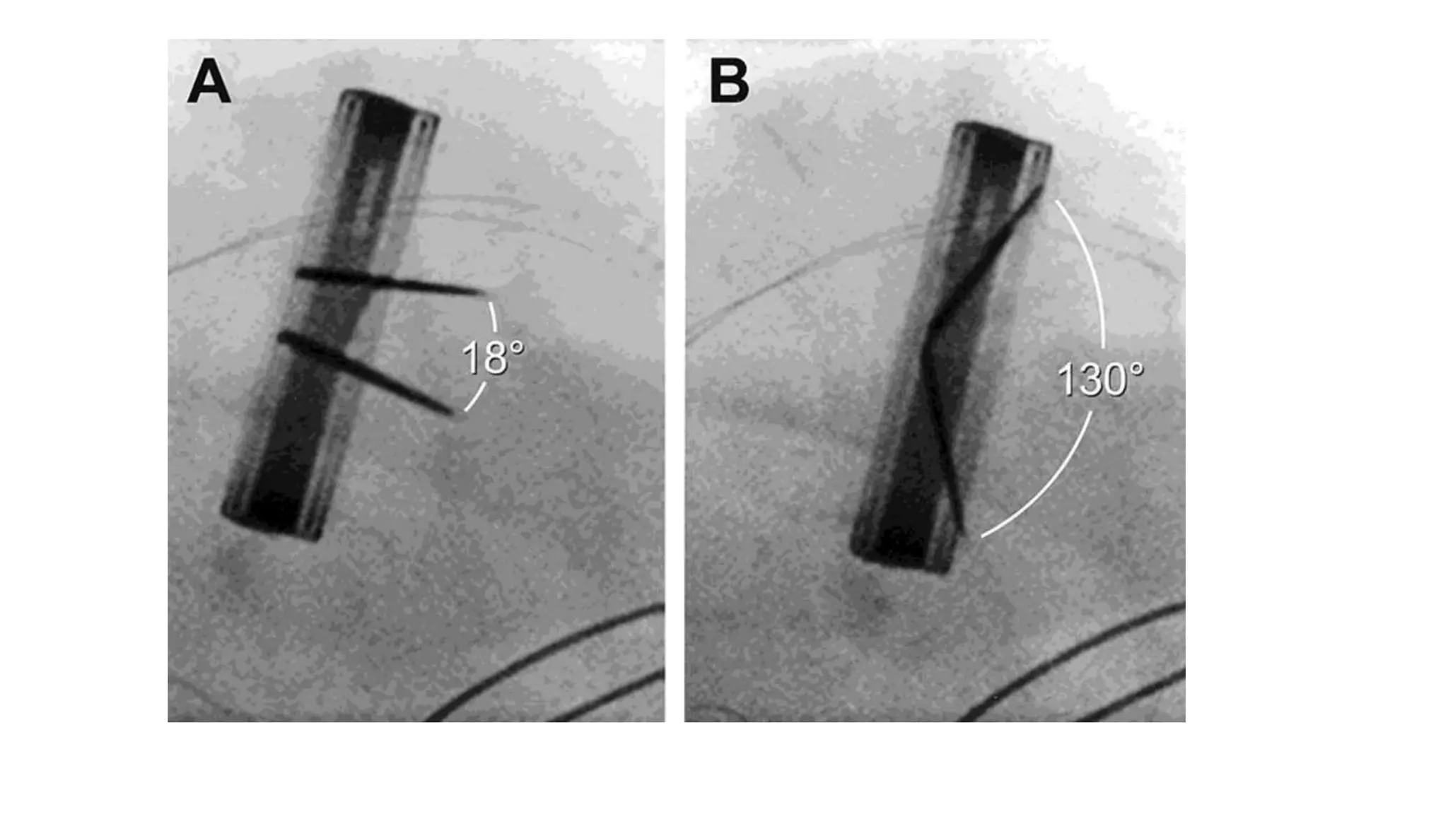 Prosthetic valve thrombosis | PPTX