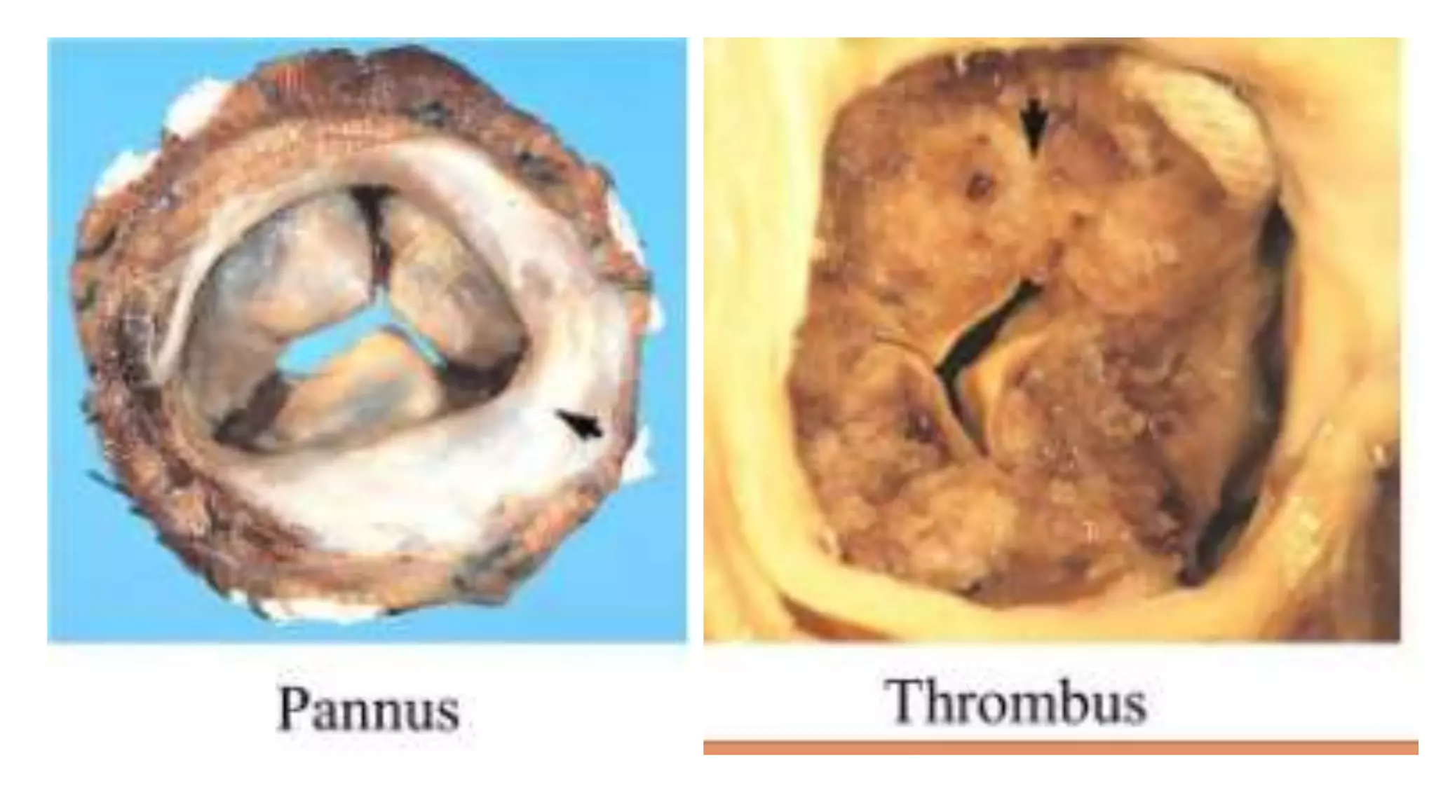 Prosthetic valve thrombosis | PPTX