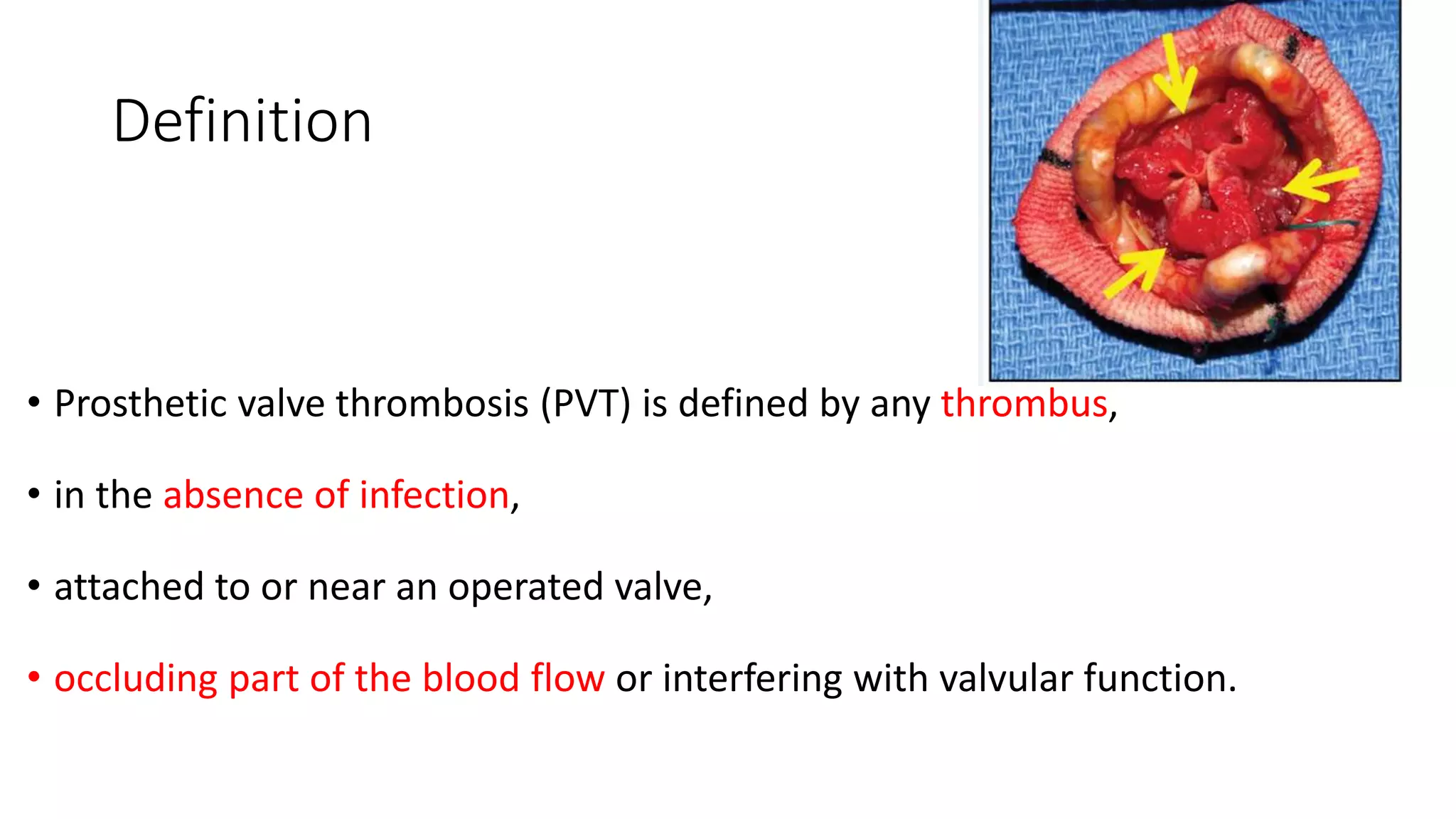 Prosthetic valve thrombosis | PPTX