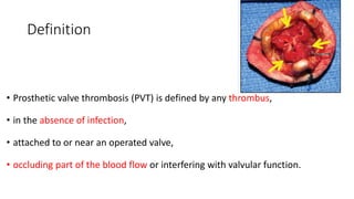 Prosthetic valve thrombosis | PPTX