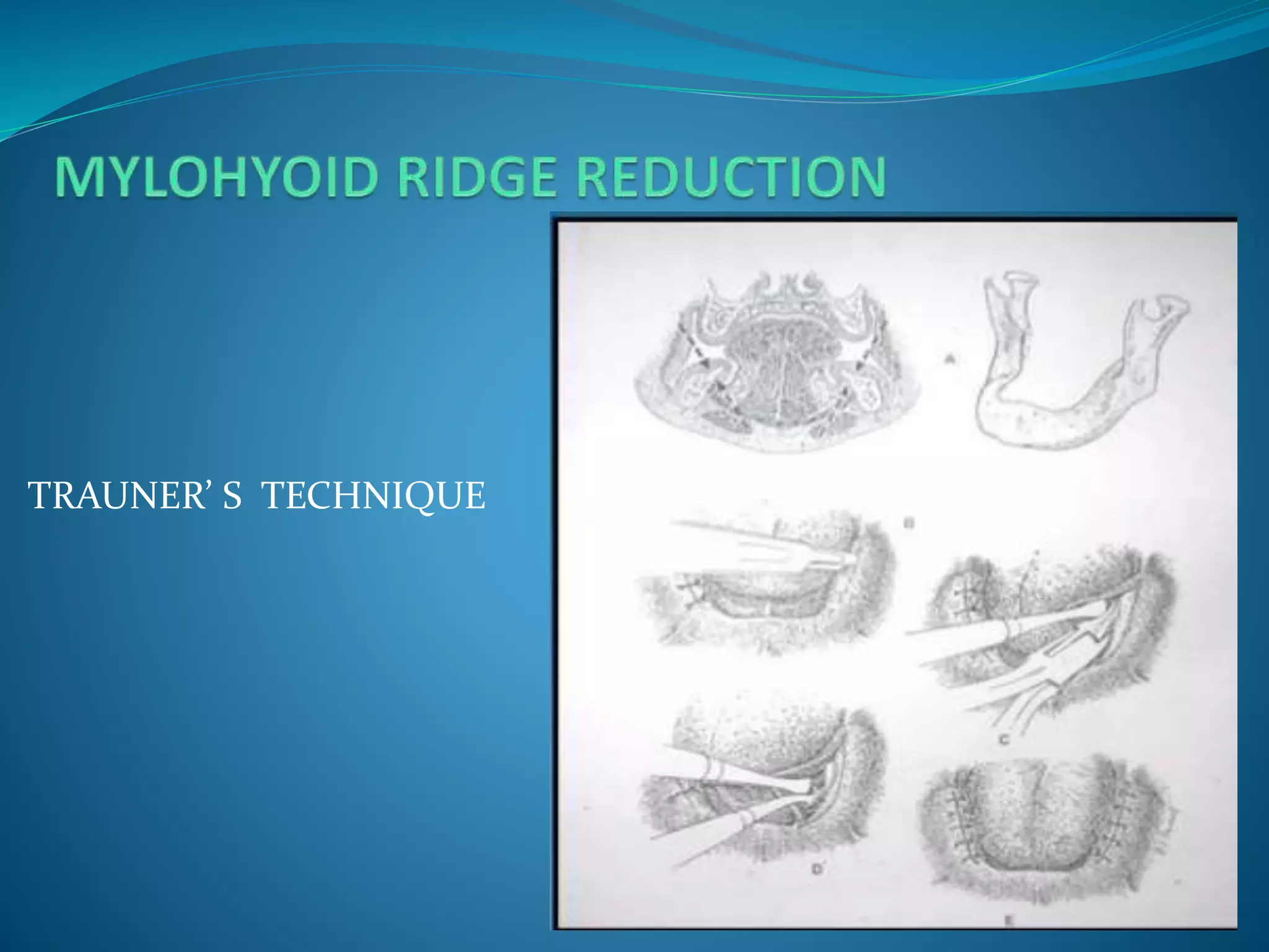 PRE PROSTHETIC FULL MOUTH PREPARATION | PPTX