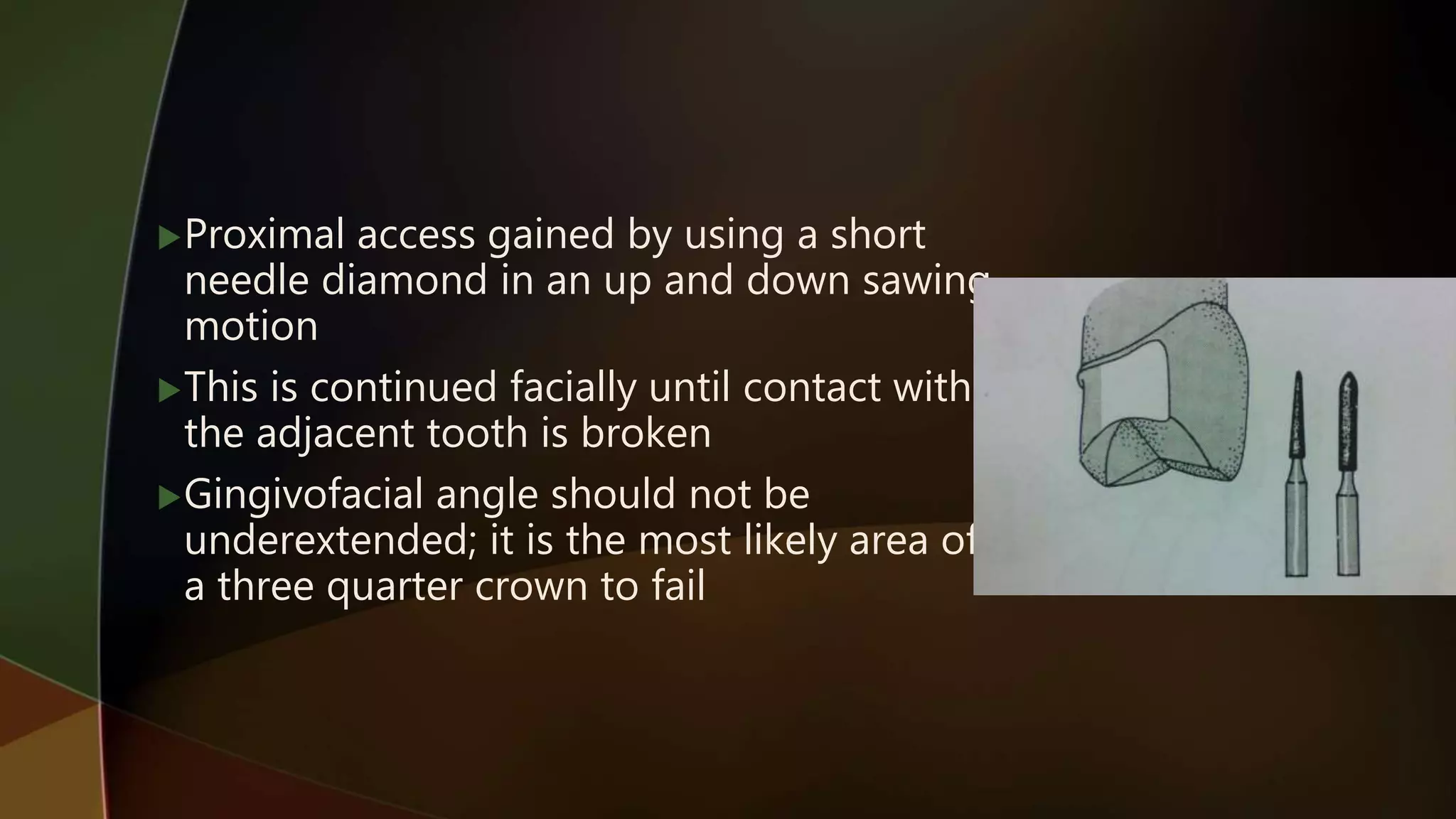 Partial veneer crown preparations | PPTX