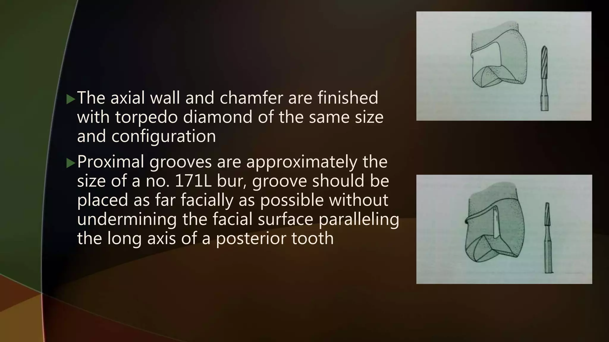 Partial veneer crown preparations | PPTX