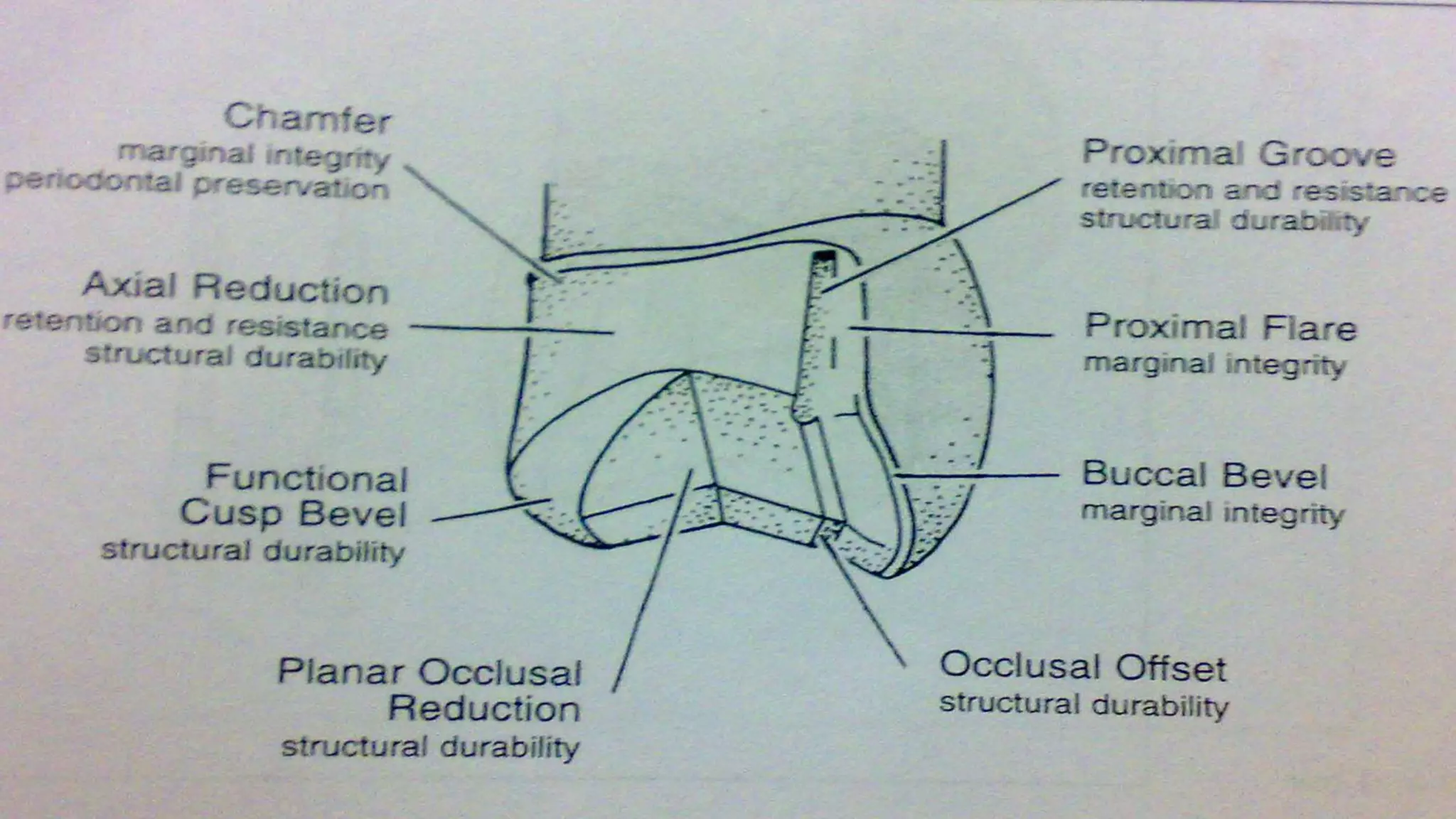 Partial veneer crown preparations | PPTX