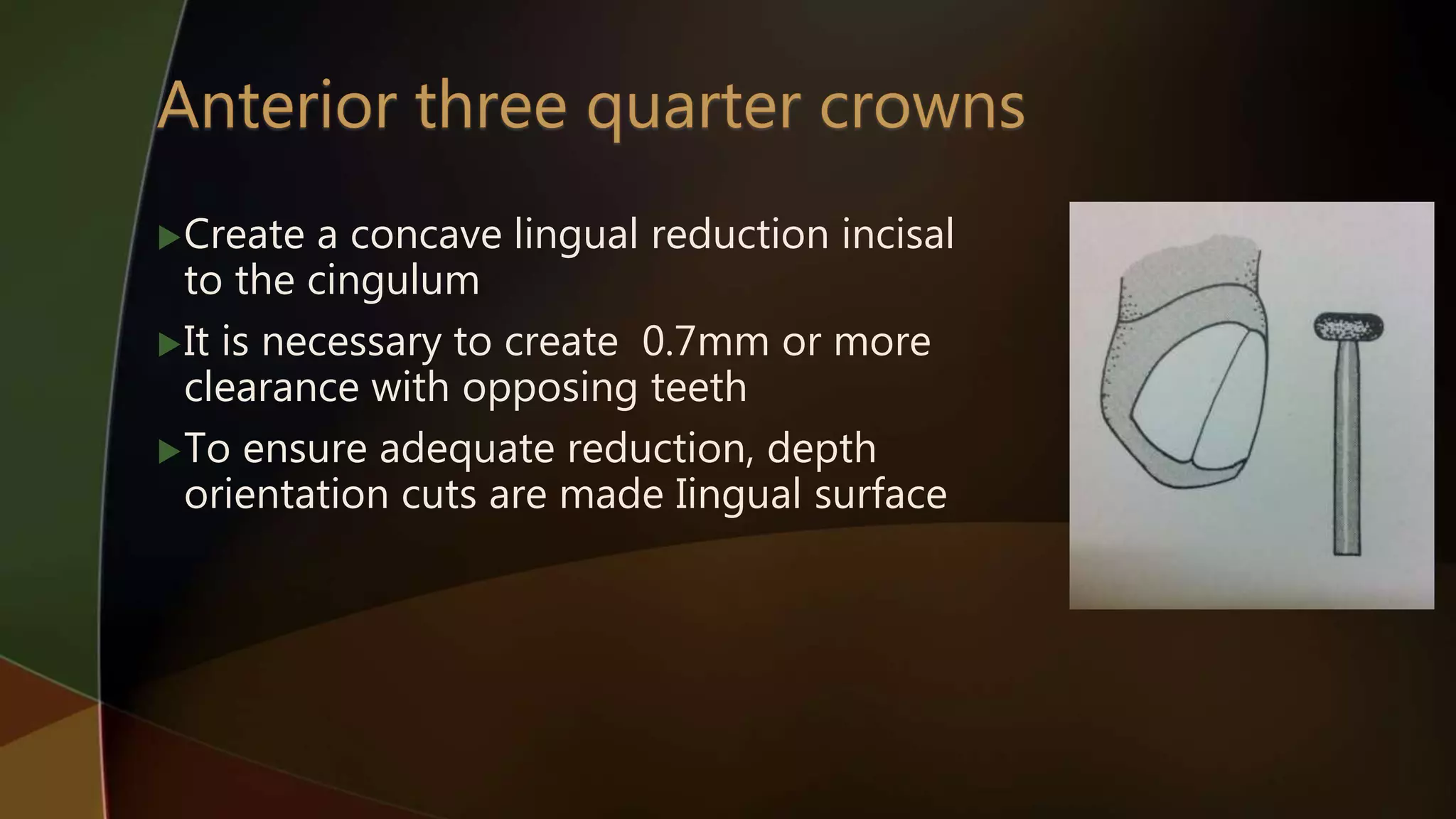 Partial veneer crown preparations | PPTX