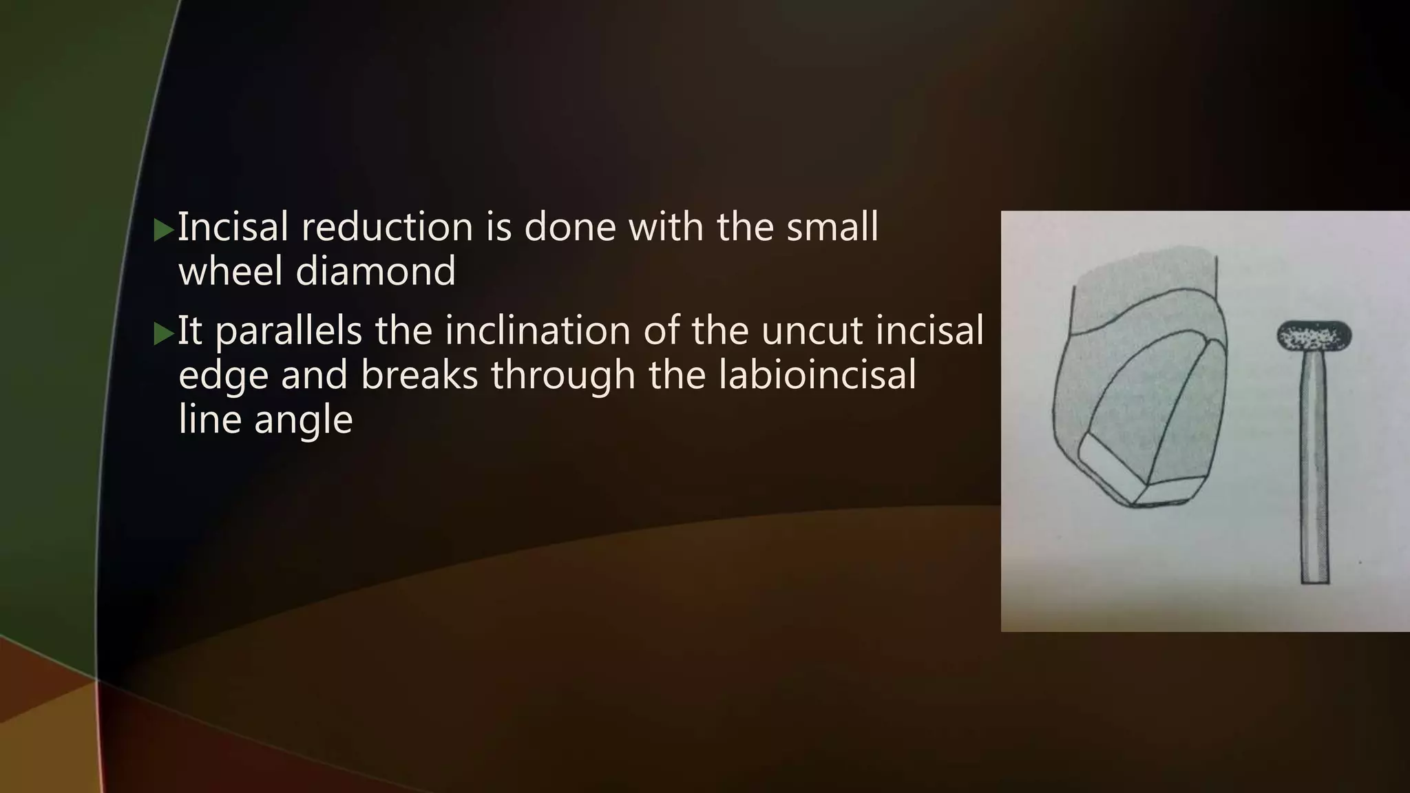 Partial veneer crown preparations | PPTX