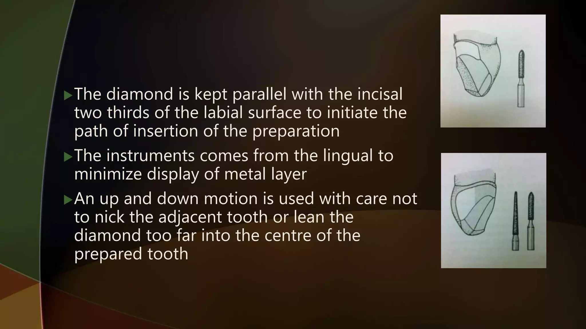 Partial veneer crown preparations | PPTX