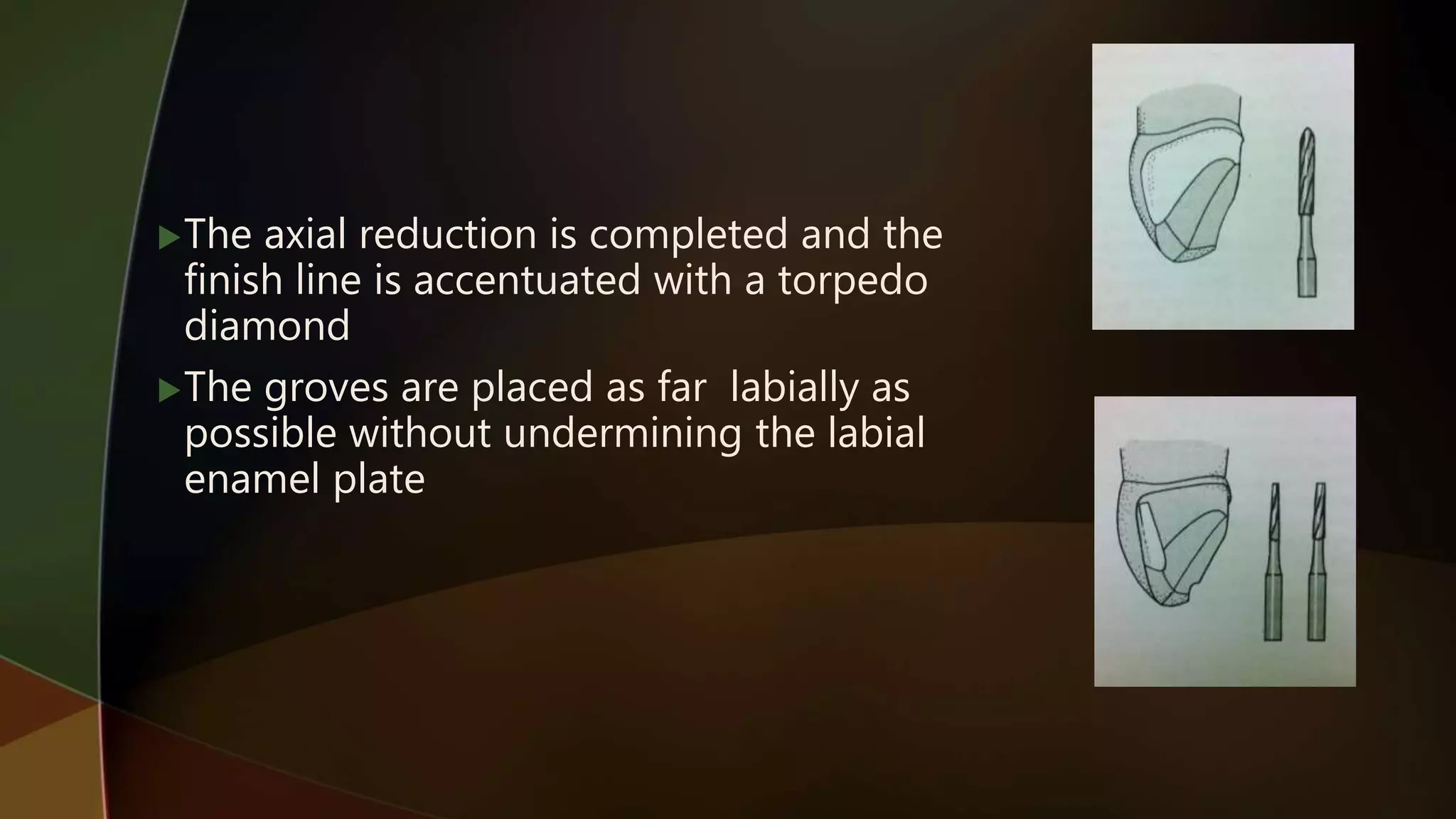 Partial veneer crown preparations | PPTX