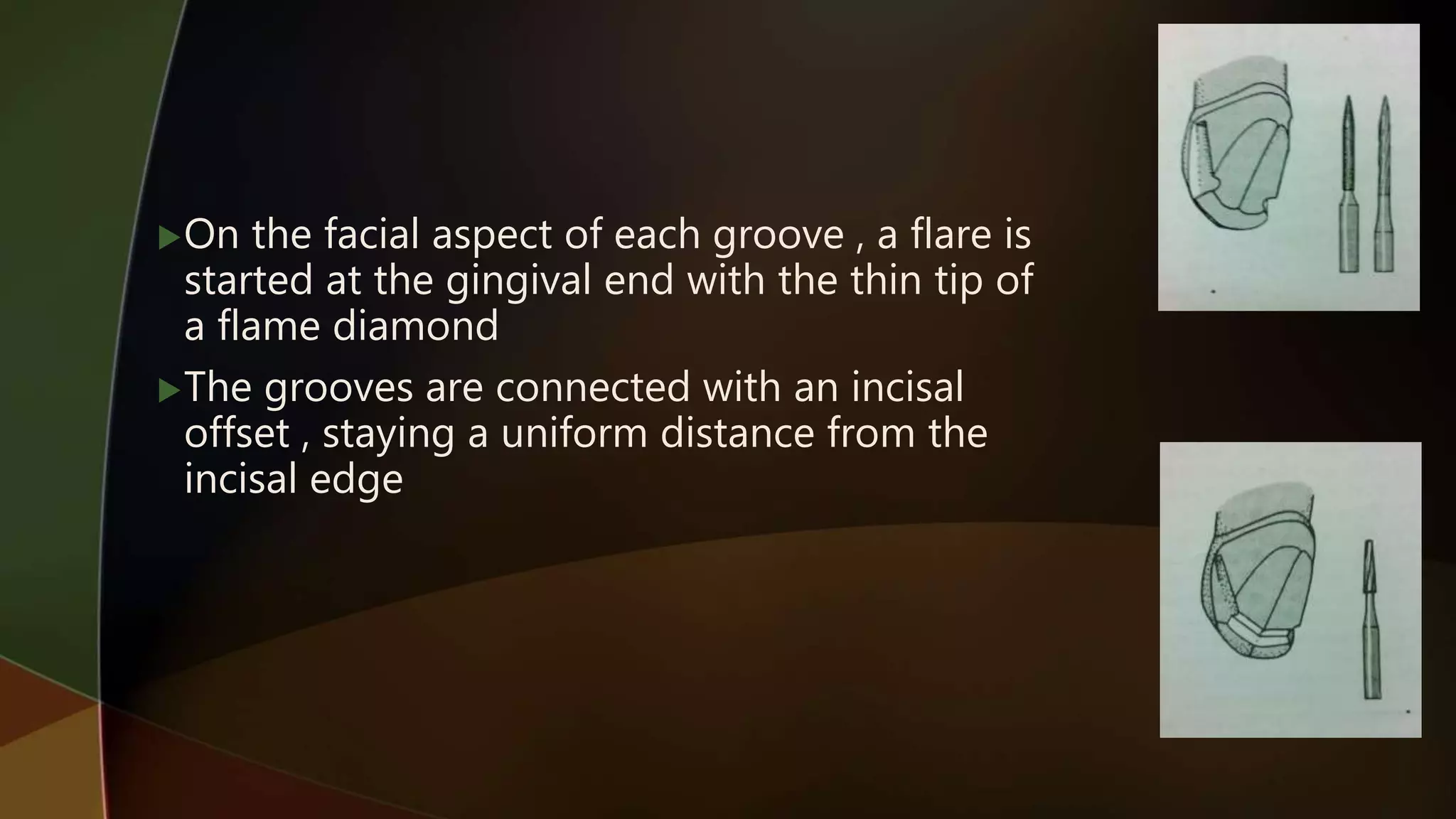 Partial veneer crown preparations | PPTX