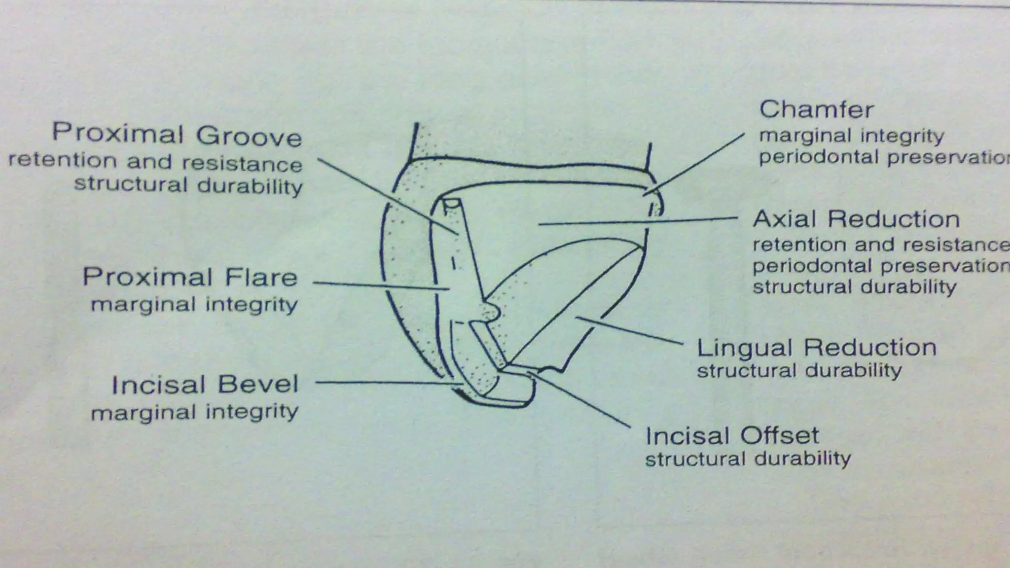 Partial veneer crown preparations | PPTX