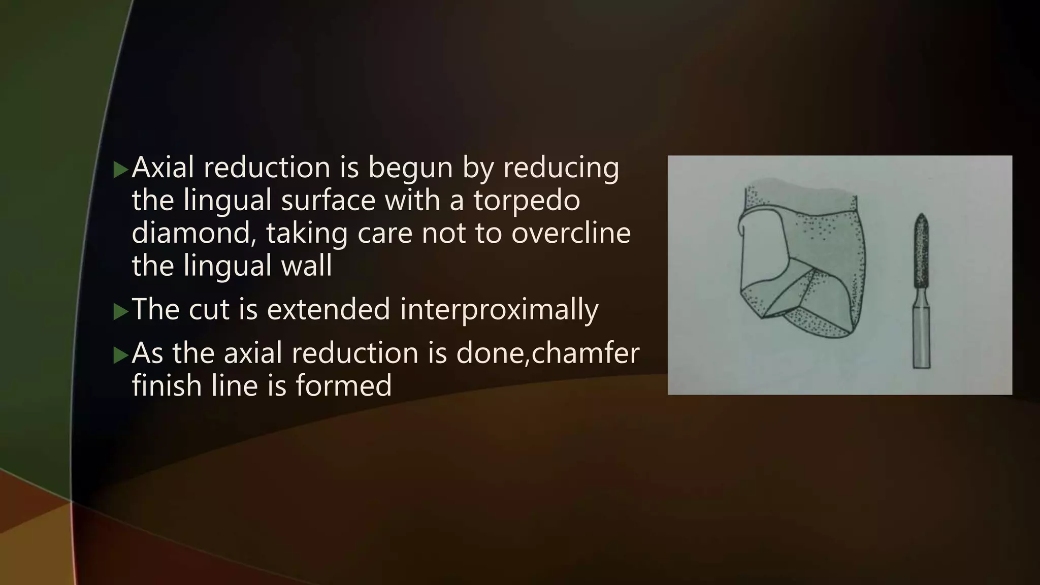 Partial veneer crown preparations | PPTX