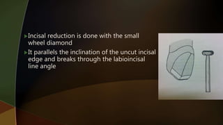 Partial veneer crown preparations | PPTX