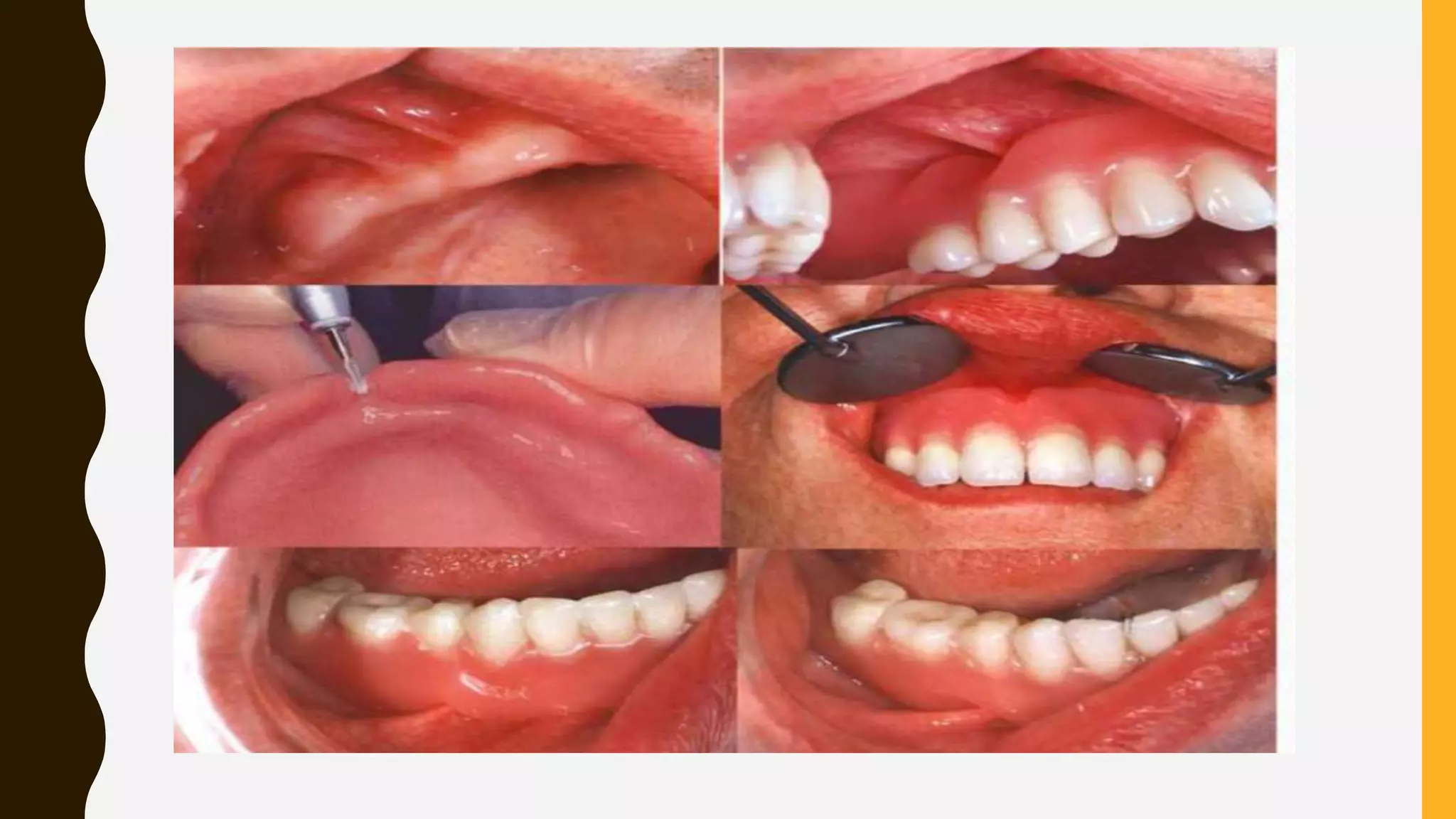 Post insertion problems in complete dentures | PPTX