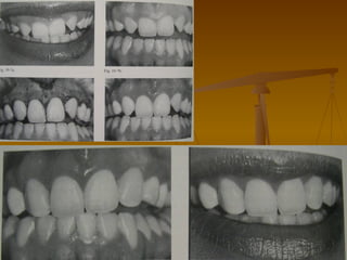 prostho-perio interdisciplanary approcah in fpd.ppt