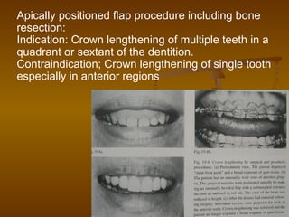 prostho-perio interdisciplanary approcah in fpd.ppt