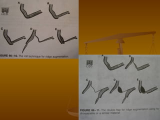 prostho-perio interdisciplanary approcah in fpd.ppt