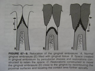 prostho-perio interdisciplanary approcah in fpd.ppt