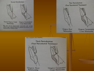 prostho-perio interdisciplanary approcah in fpd.ppt
