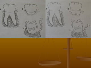 prostho-perio interdisciplanary approcah in fpd.ppt
