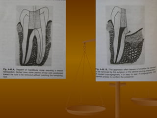 prostho-perio interdisciplanary approcah in fpd.ppt