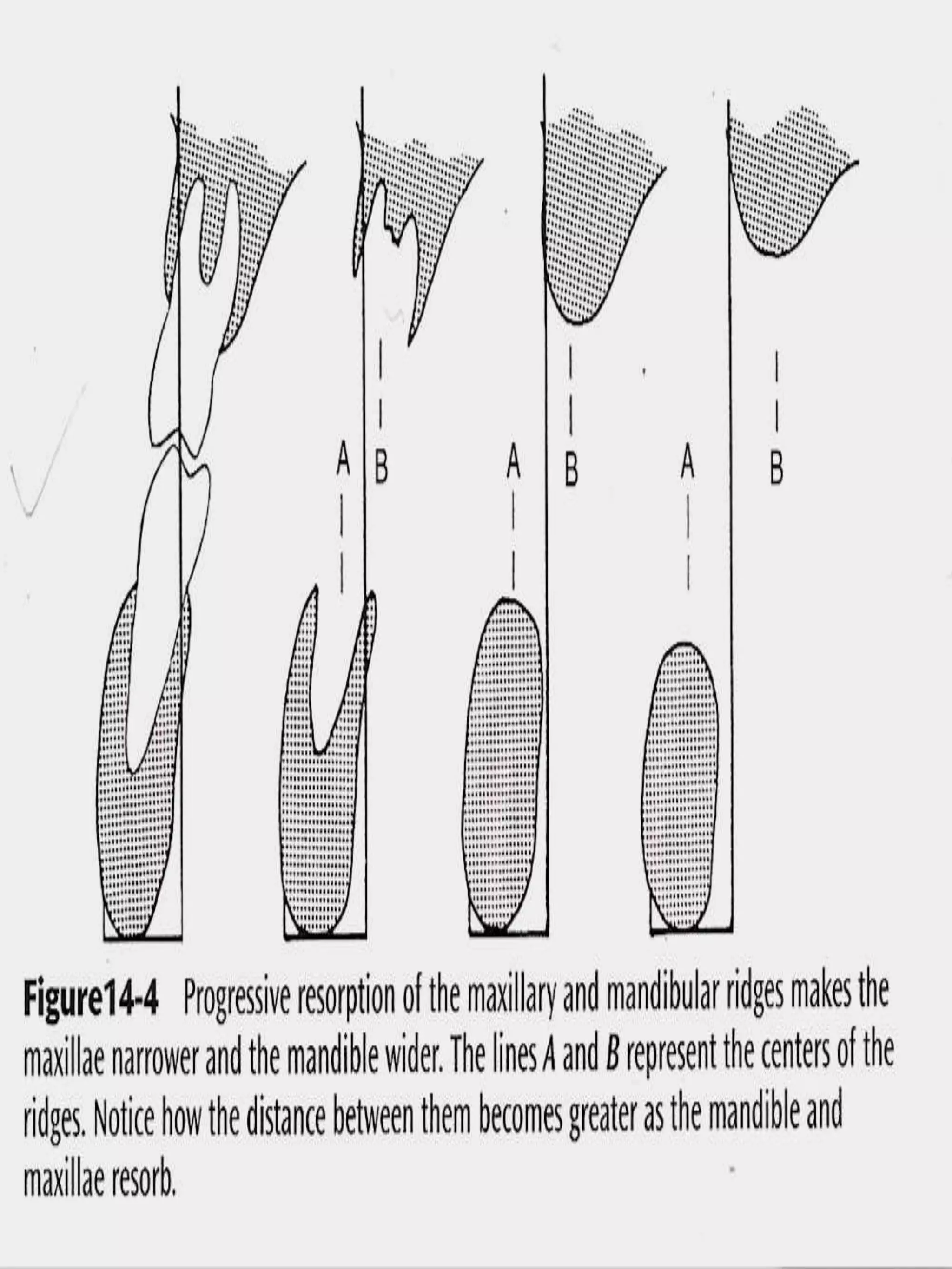 Residual Ridge Resorption | PPTX