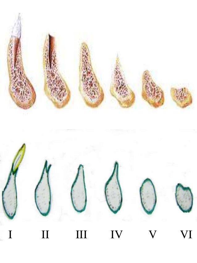 Residual Ridge Resorption