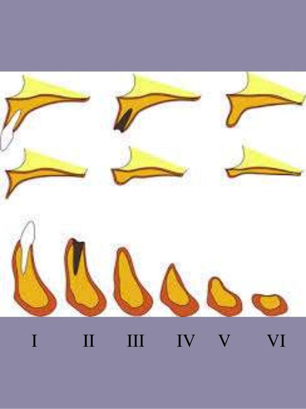 Residual Ridge Resorption