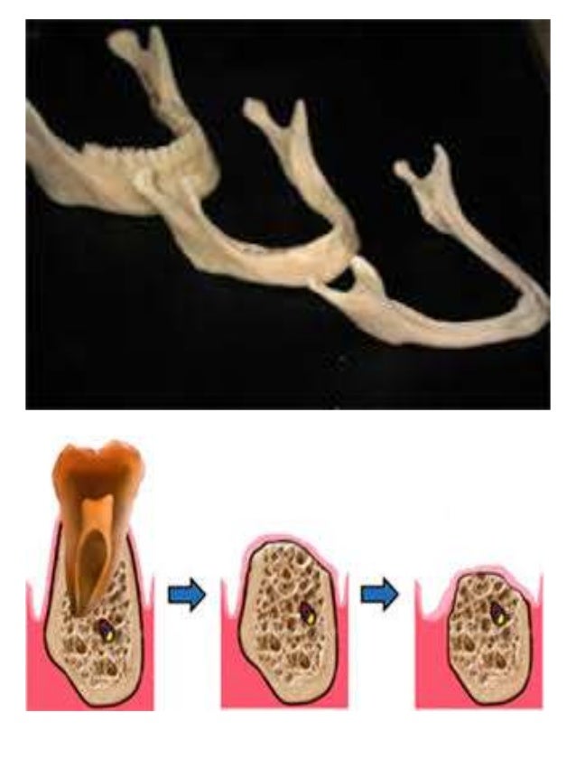 Residual Ridge Resorption