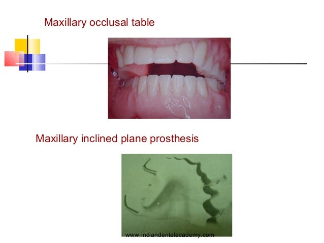 Prosthodontic management