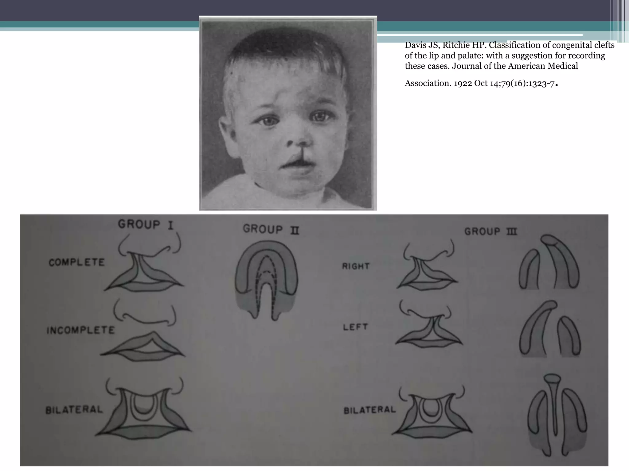 Prosthodontic management of cleft lip and palate | PPTX | Ear, Nose and Throat Conditions ...