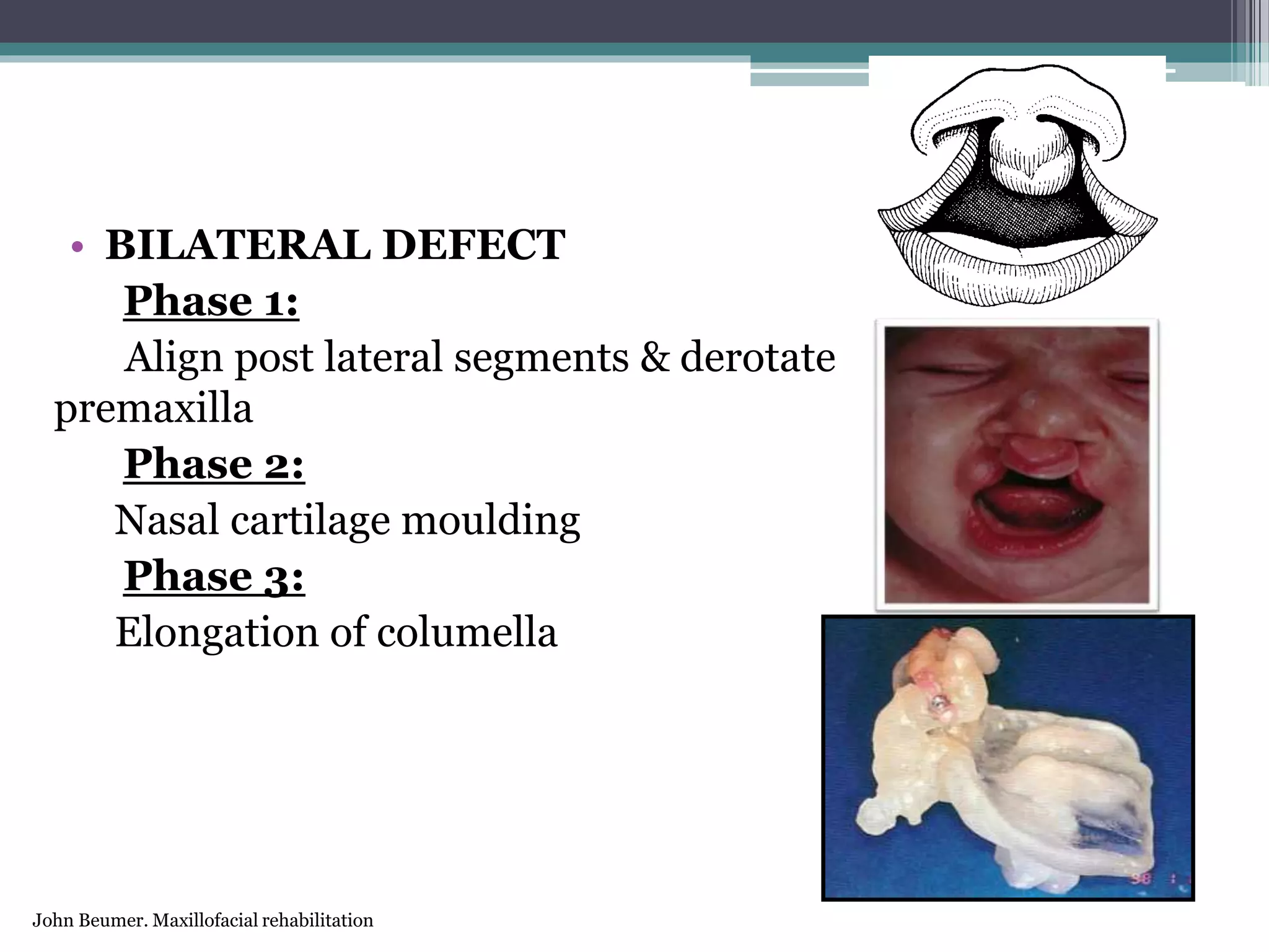 Prosthodontic management of cleft lip and palate | PPTX | Ear, Nose and Throat Conditions ...