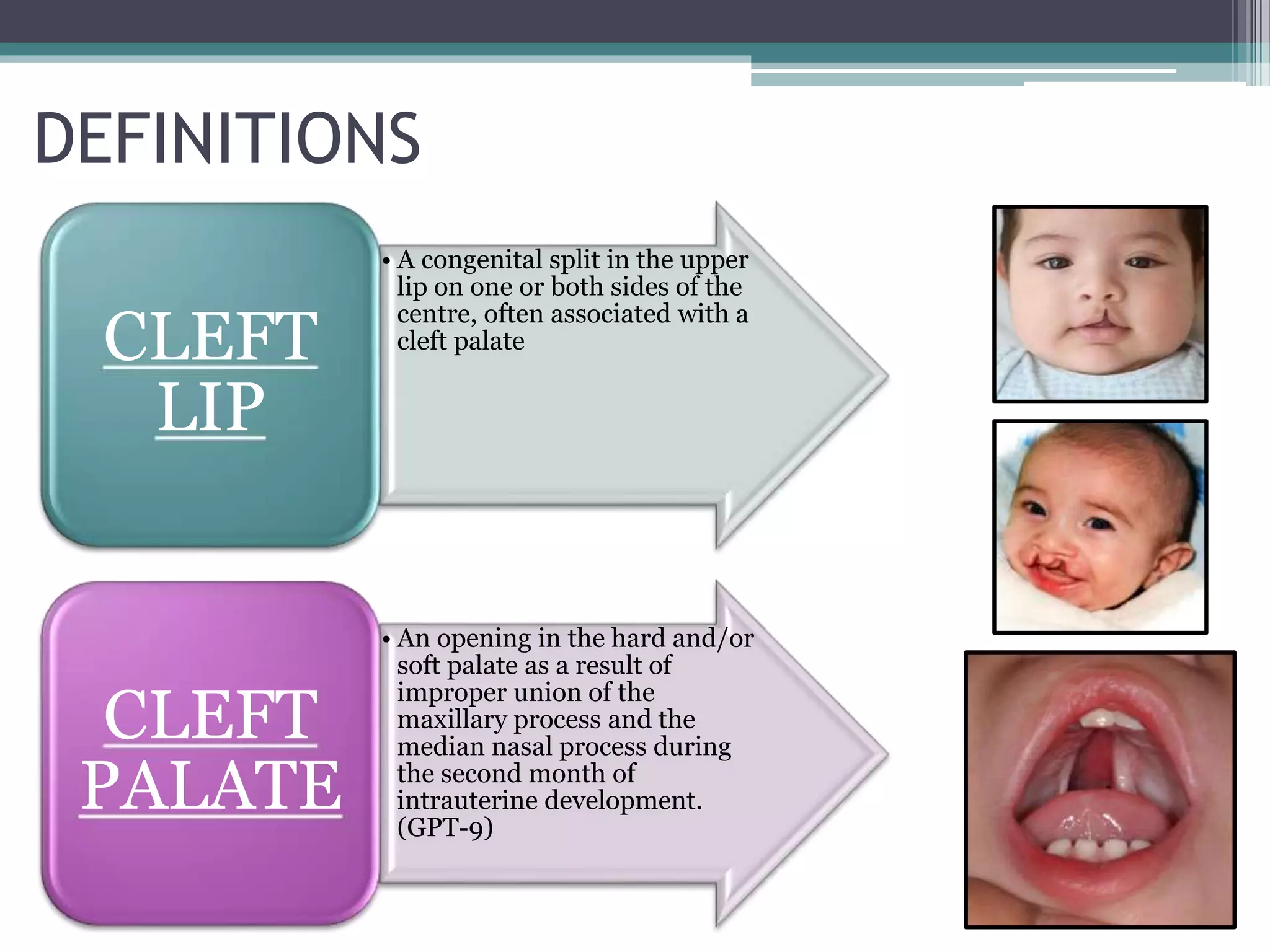 Prosthodontic management of cleft lip and palate | PPTX