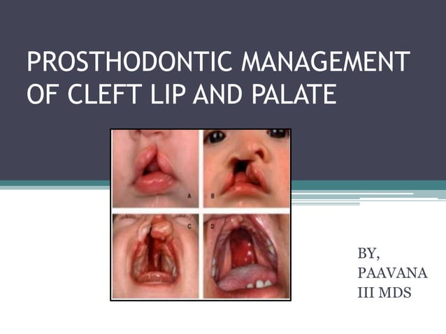Prosthodontic management of cleft lip and palate | PPTX | Ear, Nose and Throat Conditions ...