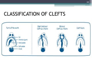 Prosthodontic management of cleft lip and palate | PPTX